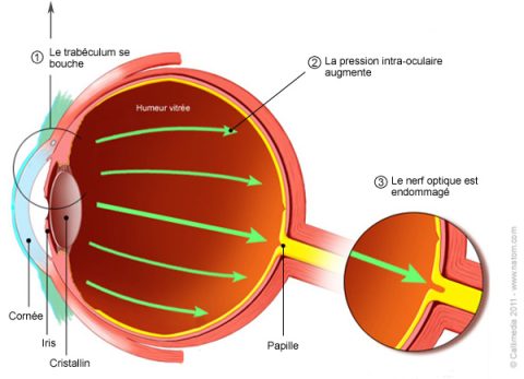 Le glaucome - OPHTABUS