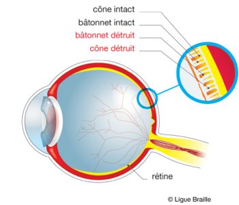 La rétinite pigmentaire - OPHTABUS